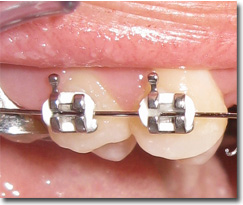 What do I need to know about metal braces? | iSmile Specialists