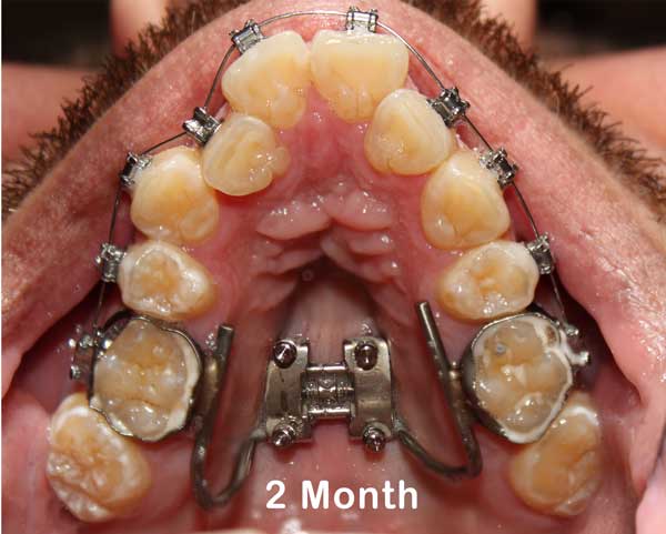 MARPE / SME as a non-Invasive alternative to SARPE | Houston