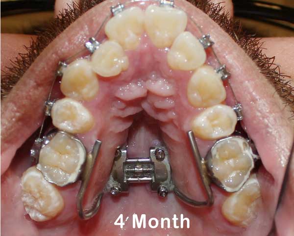 MARPE / SME as a non-Invasive alternative to SARPE | Houston