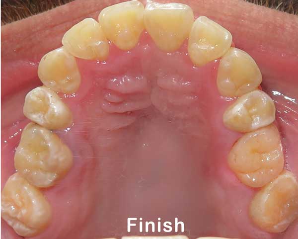 MARPE / SME as a non-Invasive alternative to SARPE | Houston