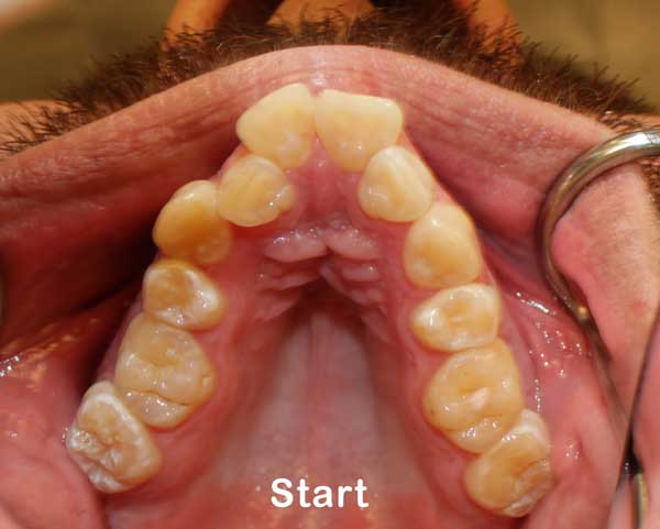 MARPE / SME as a non-Invasive alternative to SARPE | Houston