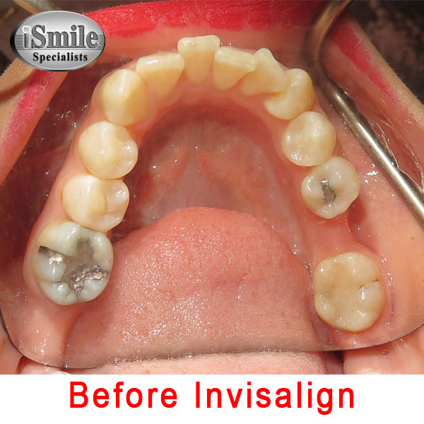Top Invisalign Providers in Houston and Sugar Land, Texas