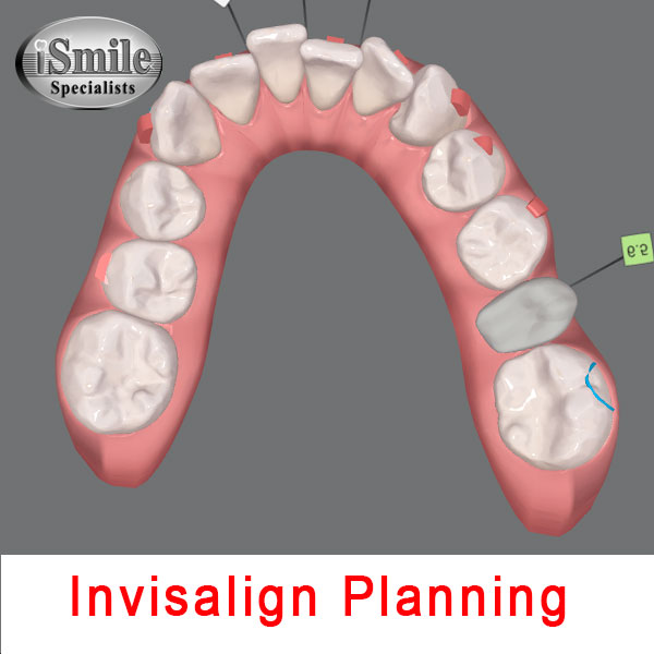 Top Invisalign Providers in Houston and Sugar Land, Texas