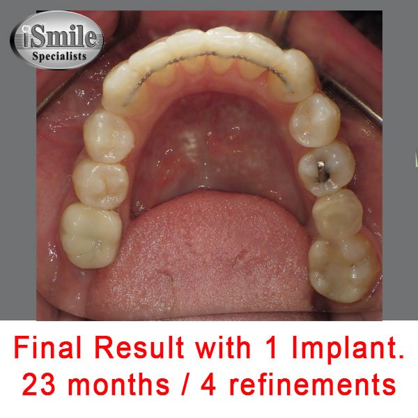 Top Invisalign Providers in Houston and Sugar Land, Texas