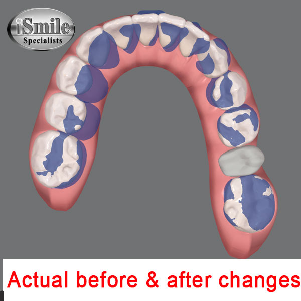 Top Invisalign Providers in Houston and Sugar Land, Texas