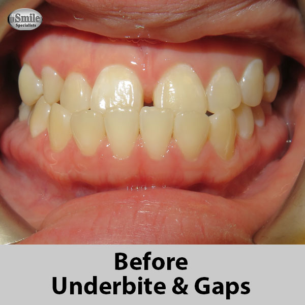 Top Invisalign Providers in Houston and Sugar Land, Texas