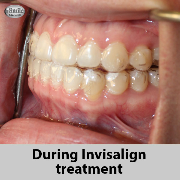 Top Invisalign Providers in Houston and Sugar Land, Texas
