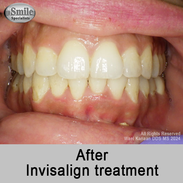 Top Invisalign Providers in Houston and Sugar Land, Texas