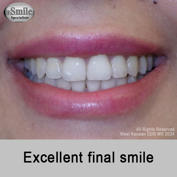 Top Invisalign Providers in Houston and Sugar Land, Texas