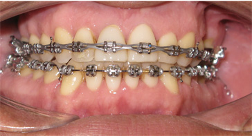 What do I need to know about metal braces? | iSmile Specialists