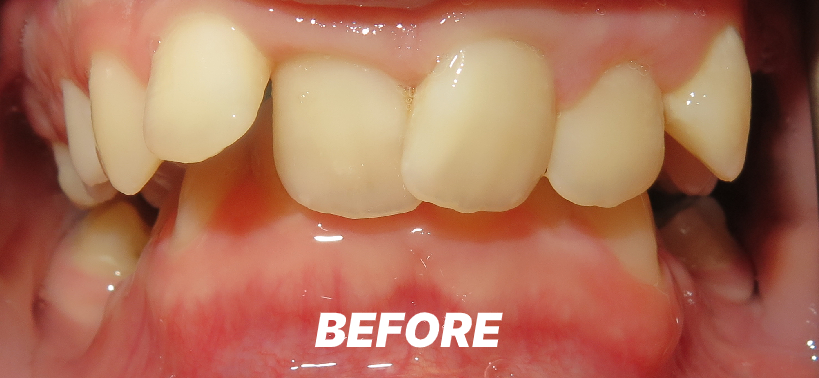 Crooked Teeth: Causes and Treatment Options | iSmile Specialists