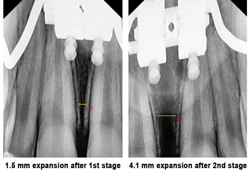 MARPE / SME as a non-Invasive alternative to SARPE | Houston
