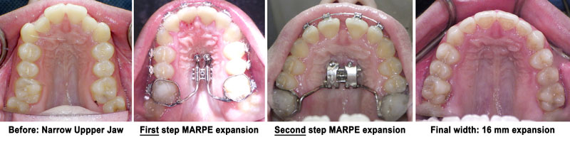 MARPE / SME as a non-Invasive alternative to SARPE | Houston