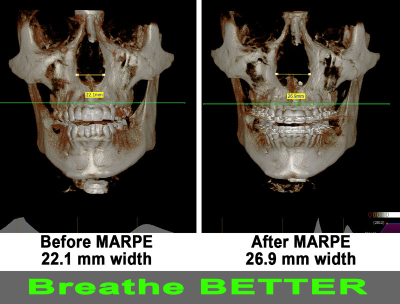 MARPE / SME as a non-Invasive alternative to SARPE | Houston
