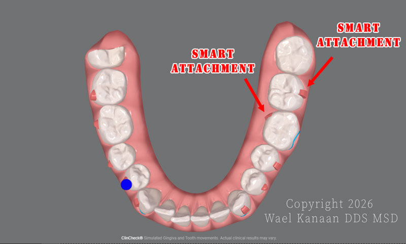 Invisalign for Underbite in Houston | Top-Rated Orthodontist