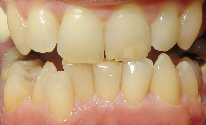 Crowded Bottom Teeth Before And After