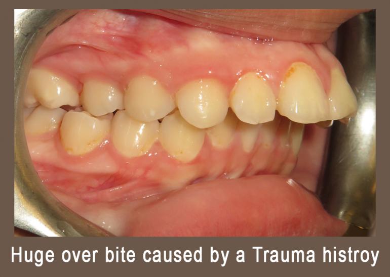 Overbite Correction in Houston and Sugarland TX