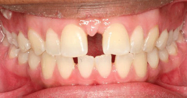 How to fix space between teeth | iSmile Specialists