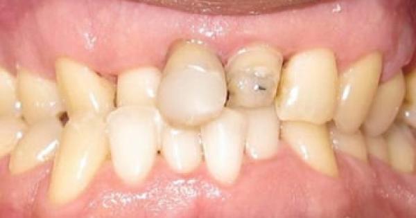 Complex Orthodontic Cases | iSmile Specialists
