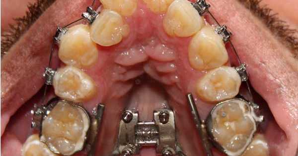 MARPE / SME as a non-Invasive alternative to SARPE | Houston