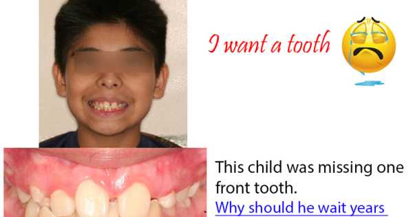 Temporary Dental Implant for Children with Missing Teeth