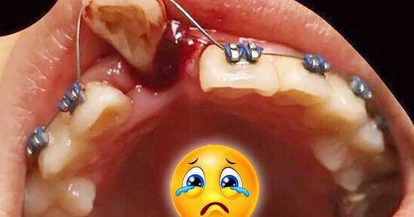 Managing a Loose Tooth After an Accident with Braces | Sugar Land ...