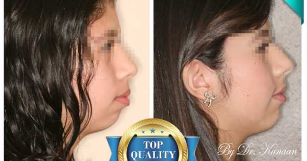 Orthodontic Solutions for Protruding Teeth & Full Profile