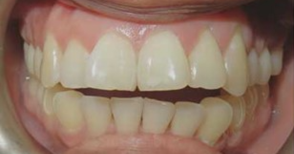 Anterior open bite correction with Invisalign